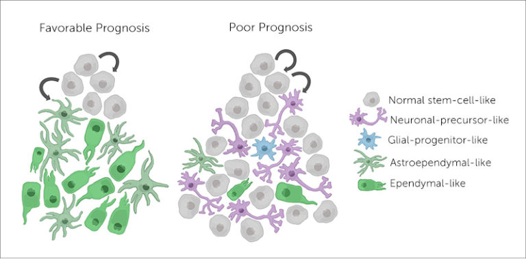 Insights on aggressive ependymomas - Boston Children's Answers