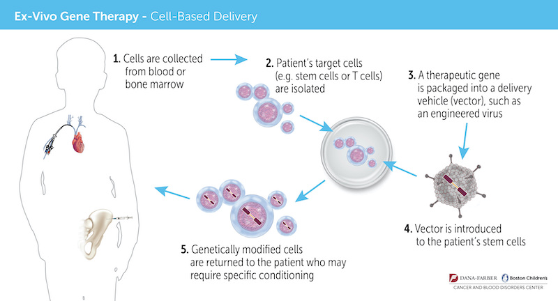 Gene therapy for ALD: Matthew's story - Boston Children's Answers