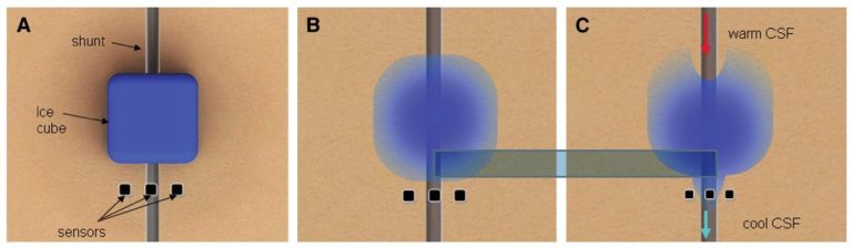 Detecting shunt failure in hydrocephalus without imaging or surgery ...
