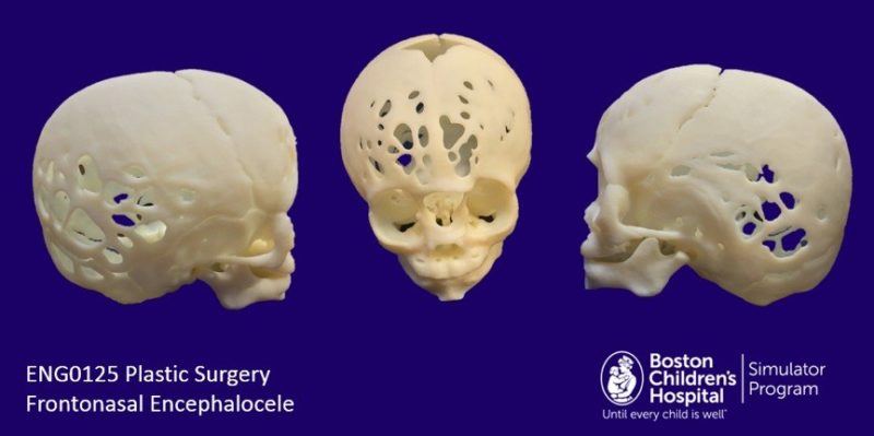 SIMPeds creates medical models for surgical planning - Boston Children ...