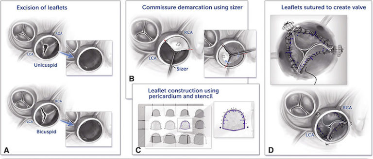 Bringing the Ozaki procedure to children worldwide - Boston Children's ...