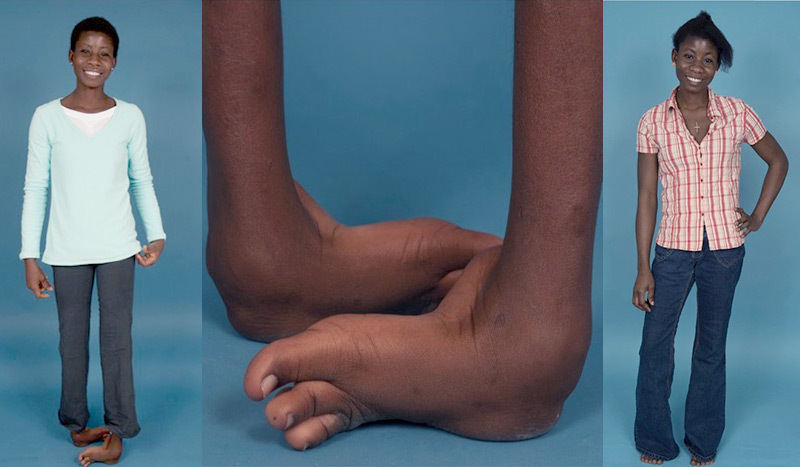 Two very different clubfoot treatments - Boston Children's Answers