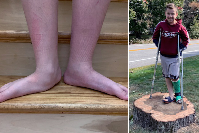 Quinn's flatfoot surgery - Boston Children's Answers