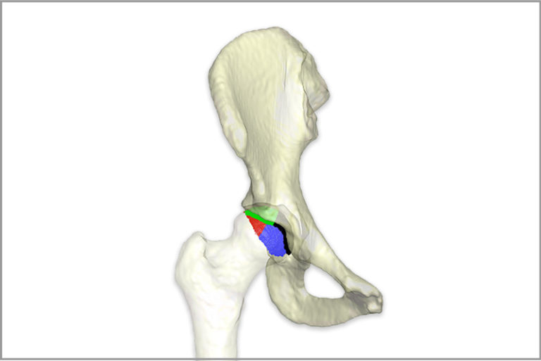 AI and hip preservation - Boston Children's Answers