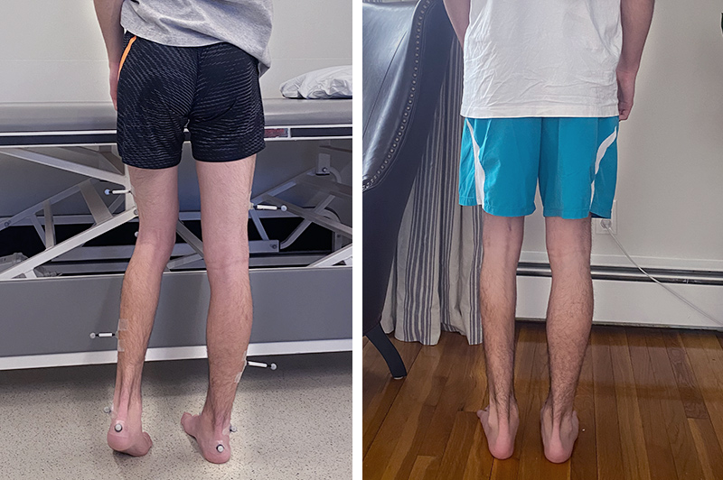 Cerebral palsy and lacrosse - Boston Children's Answers