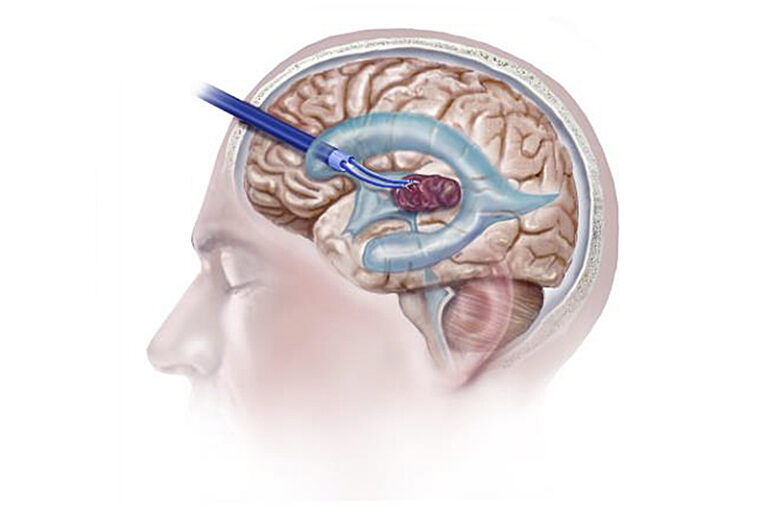 This neurosurgical robot goes deep into the brain - Boston Children's ...