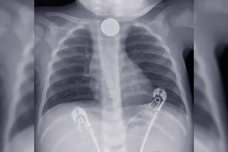 An off-the-shelf tamponade kit provides surgeons with 'the luxury of ...