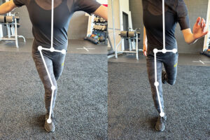 Why are ACL tears so common among female athletes?
